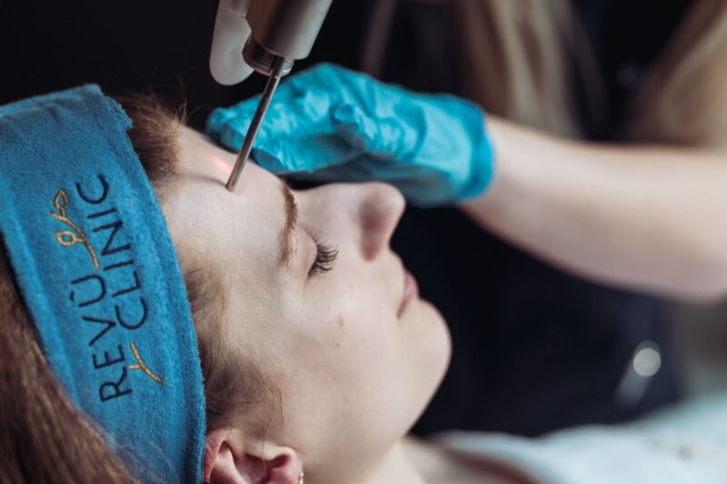 Kapiliarų šalinimas lazeriu - REVÙ CLINIC